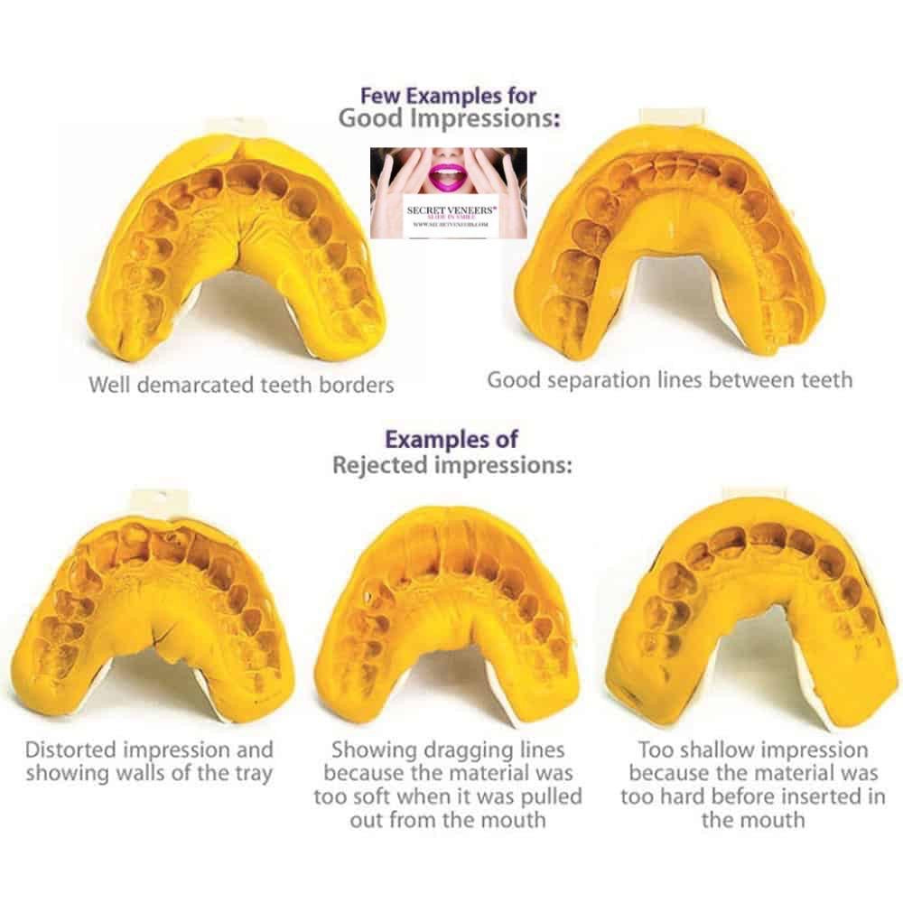 Spare 3x Extra Dental Putty Pots – Secret Veneers