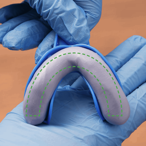 Spare 3x Extra Dental Putty Pots – Secret Veneers